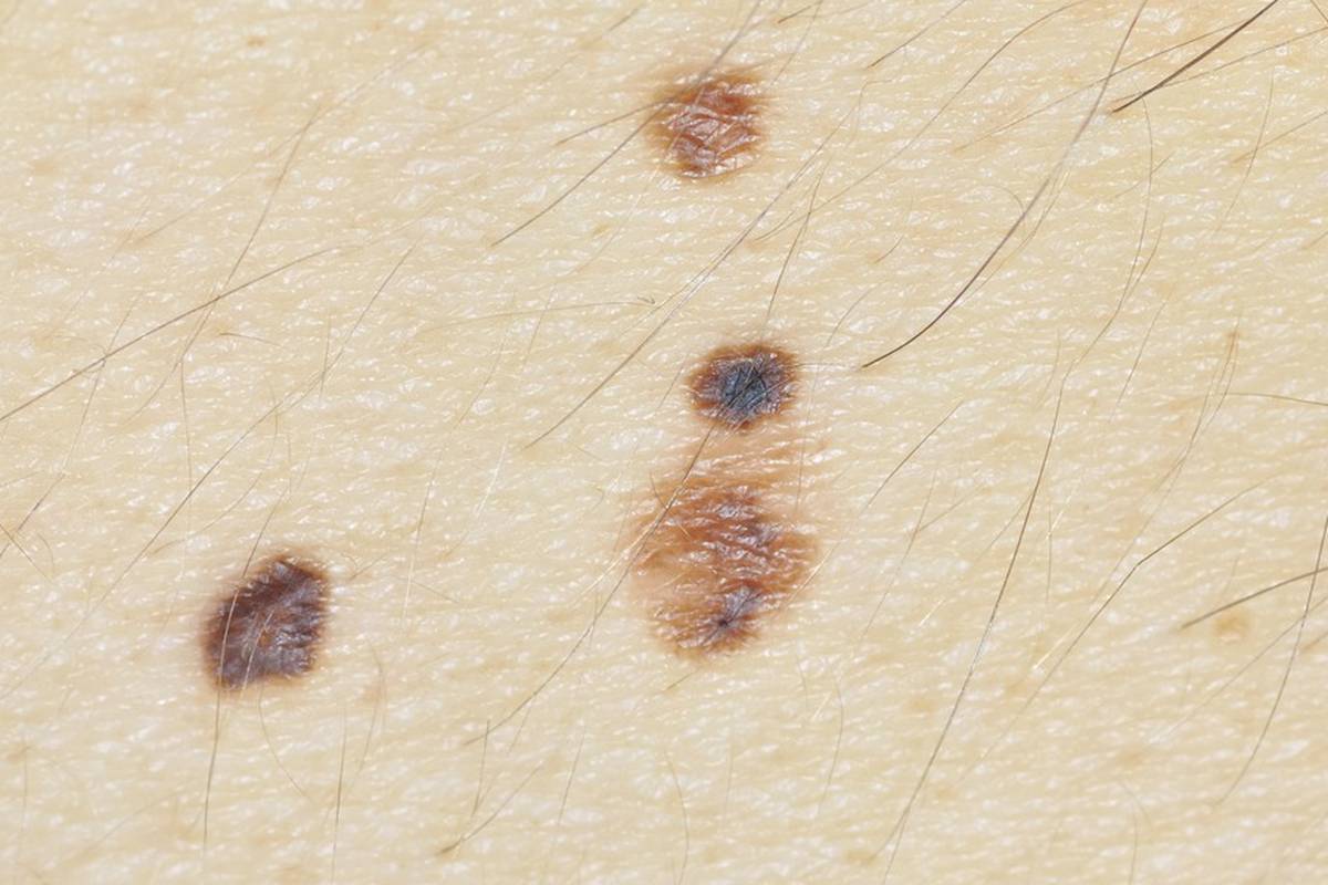 Melanom: Simptomi su svrbež, peckanje i nepravilni rubovi | 24sata