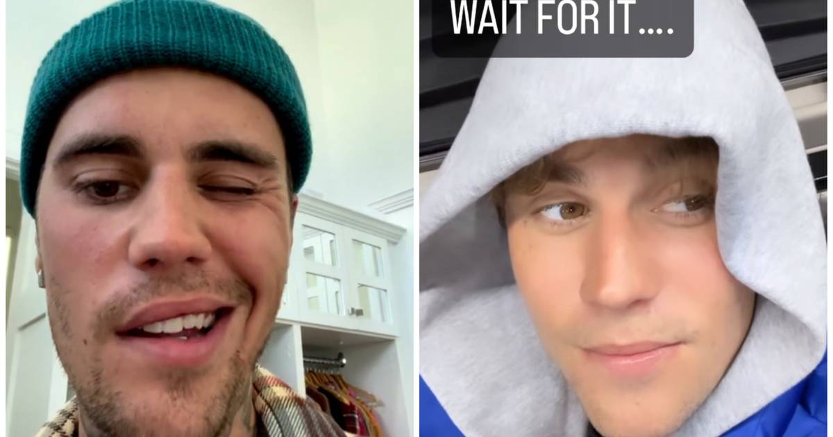 Justin Bieber snimio video kako pomiče lice zbog teške borbe sa ...