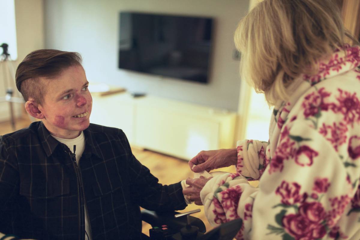 Živi u agoniji: Na njegovoj koži stvaraju se opekline i plikovi | 24sata